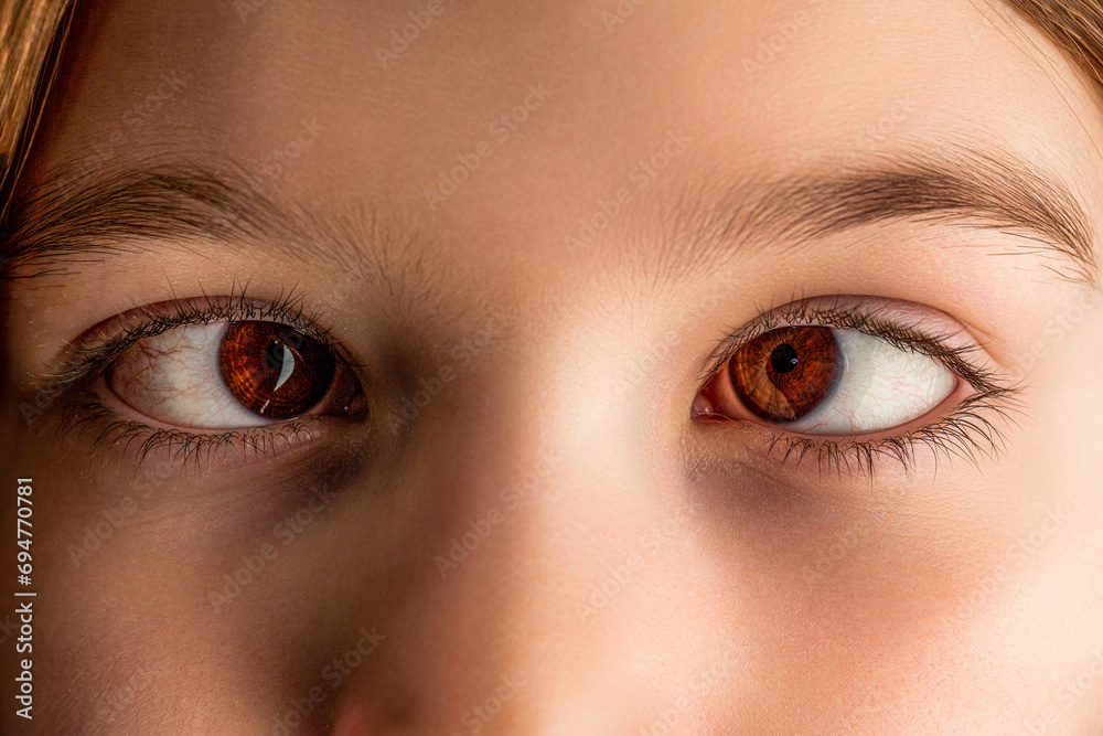 Little patient strabismus, treatment ophthalmic diseases. Strabismus in ...