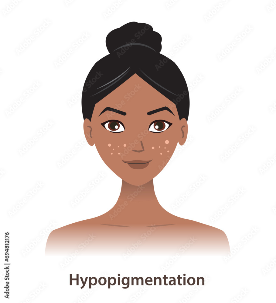 Hypopigmentation and white spots on woman face vector isolated on white ...