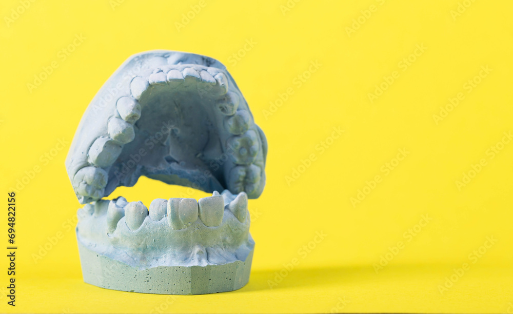 Blue plaster impression of a patient's dental jaw with crooked teeth ...
