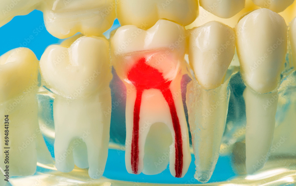 Mockup of a dental jaw with diseased teeth. Inflamed tooth canal ...