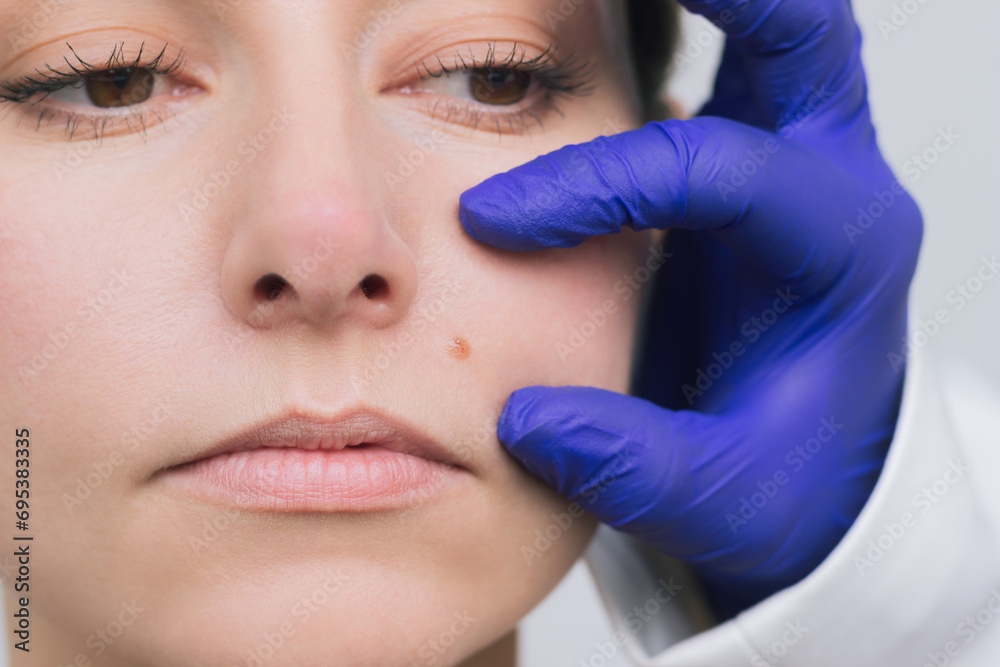 the mole above the lip on the face of a young woman increases in size ...