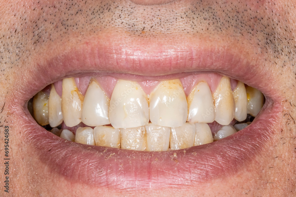 Frontal view of a smiling man, dental maxillary and mandibular arches ...