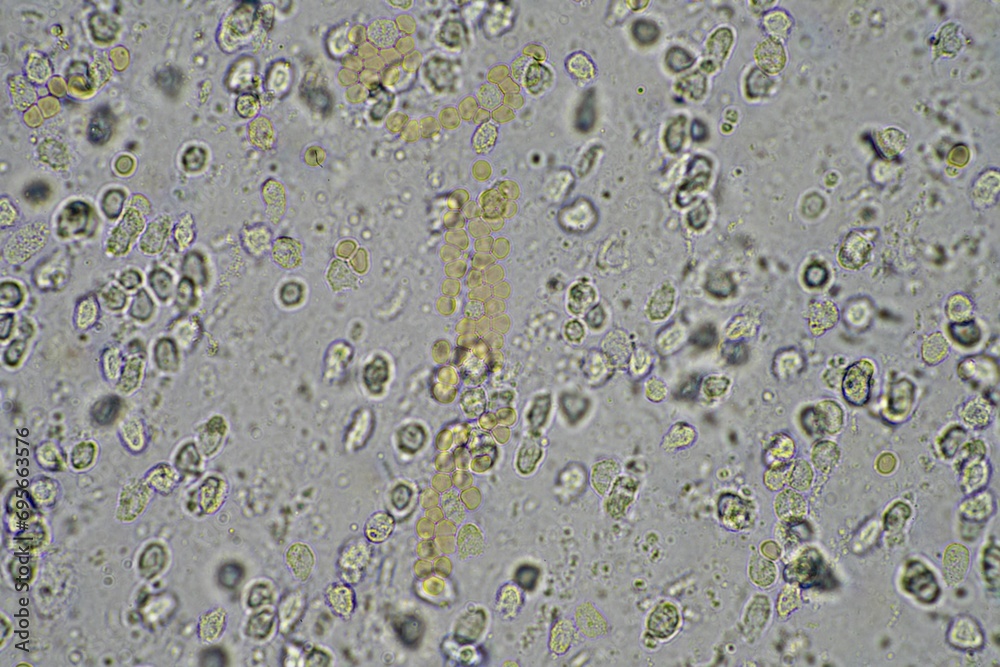 Poster Coughing up mucus and phlegm from a chest infection from a virus ...