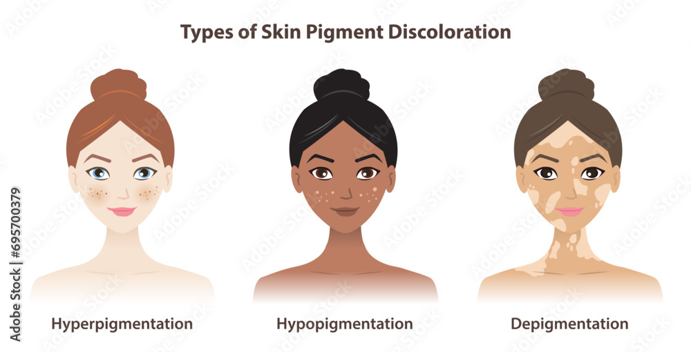 Types of skin pigment discoloration vector isolated on white background ...