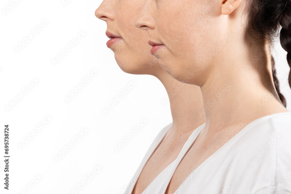 Overbite dental occlusion. Woman's face before and after correction of ...