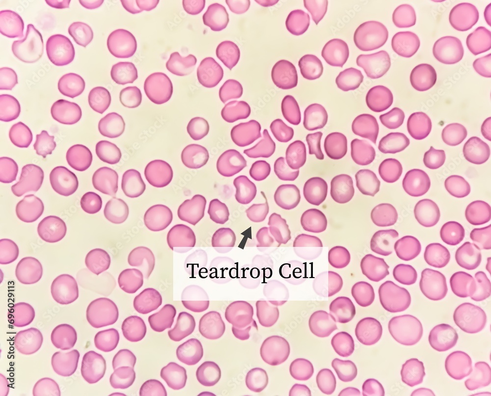 Teardrop cells (dacrocytes) are frequently associated with infiltration ...