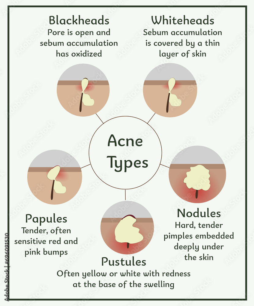 Acne types. Medical illustration. Infographic about skin and ...