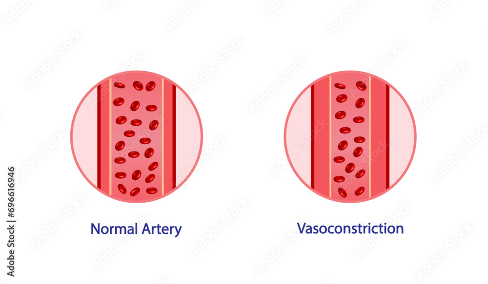 Arterial vasoconstriction. Cross section of arteries. Comparison of ...