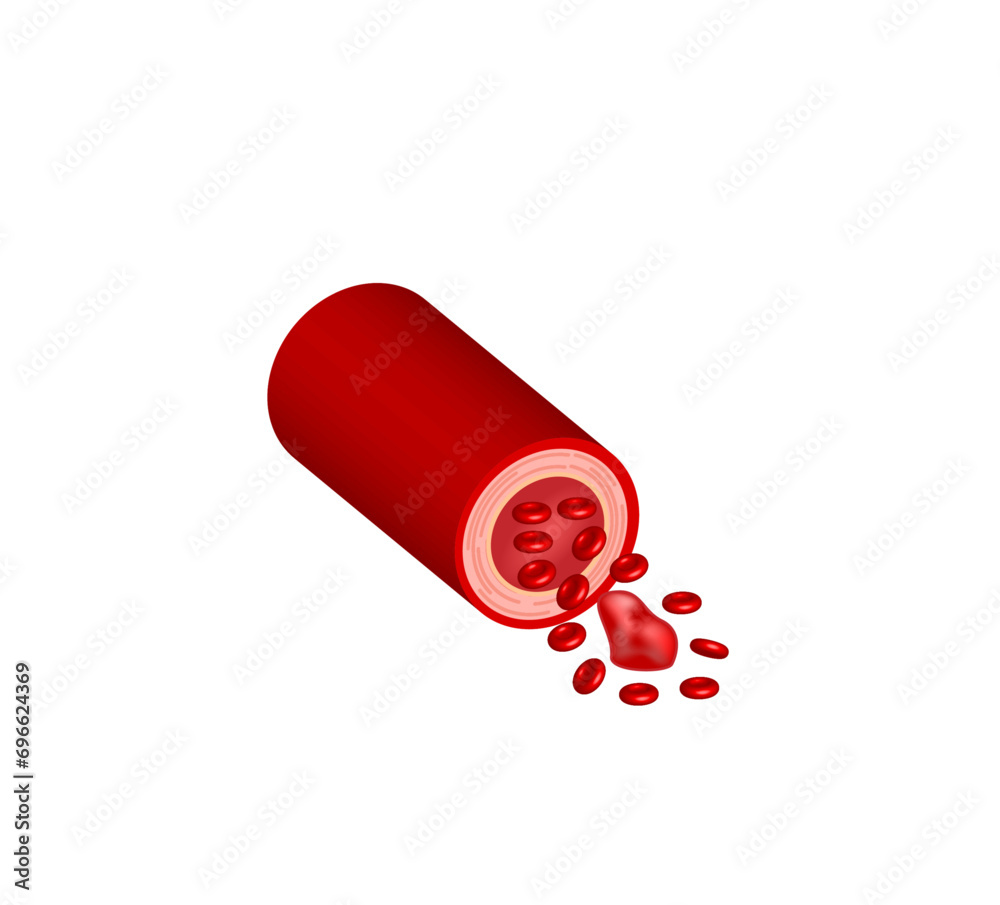 Thromboembolism. Circulating blood clot. Normal blood flow and a ...