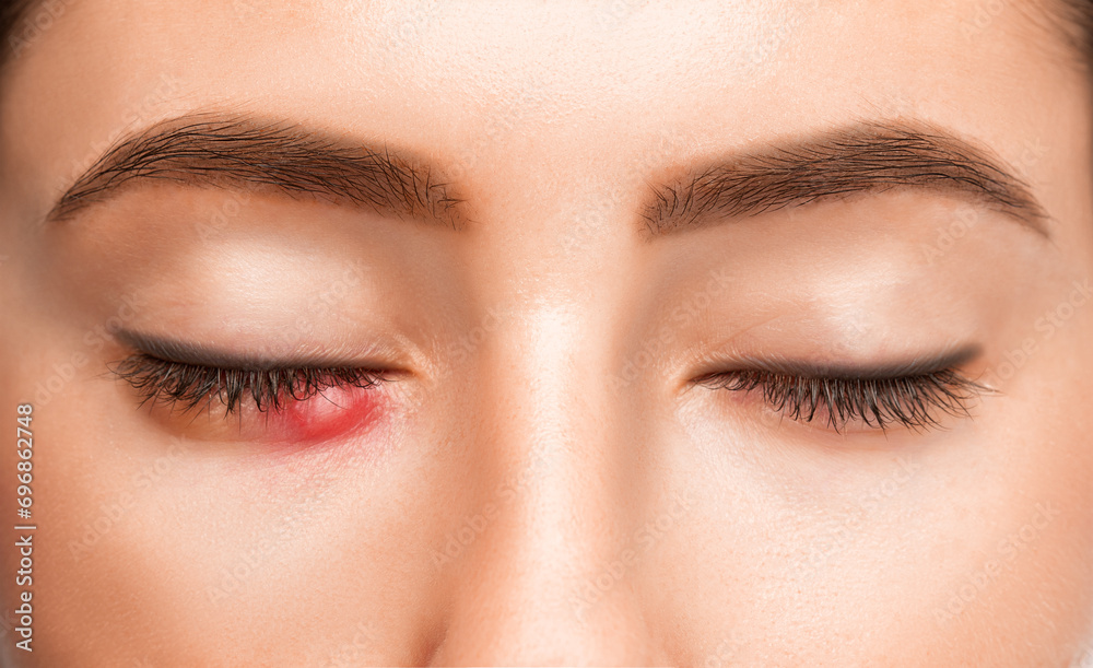 Eyes of a girl with stye close-up. Acute purulent inflammation of the ...