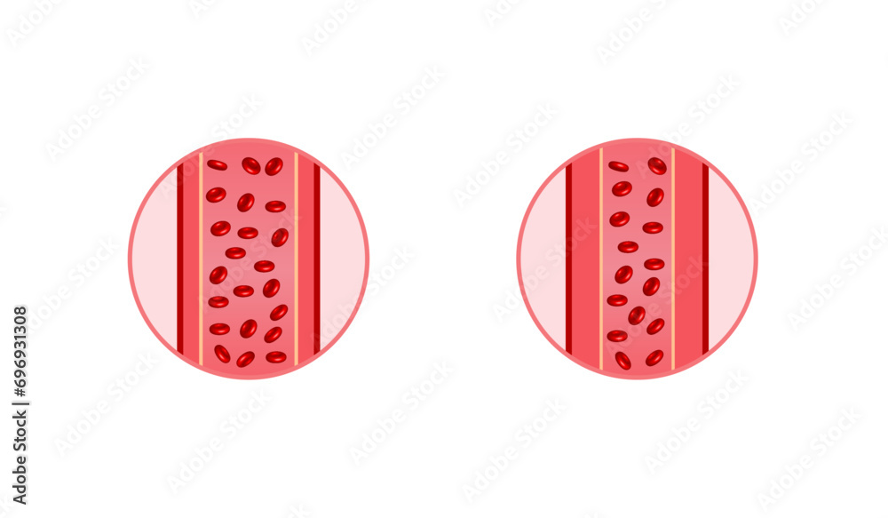 Arterial vasoconstriction. Cross section of arteries. Comparison of ...