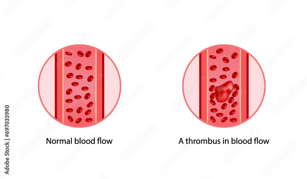 Vecteur Stock Thromboembolism. Circulating blood clot. Normal blood ...