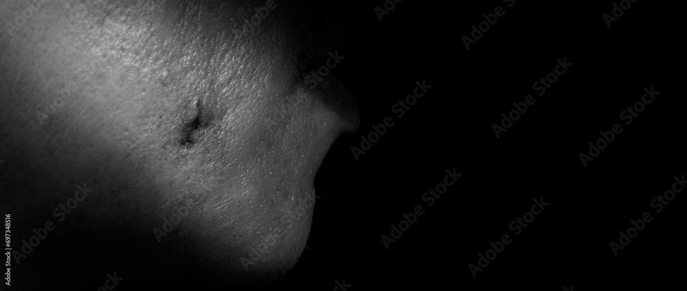 Scars from facial abscess or big acne surgery. Scars from inflammation ...