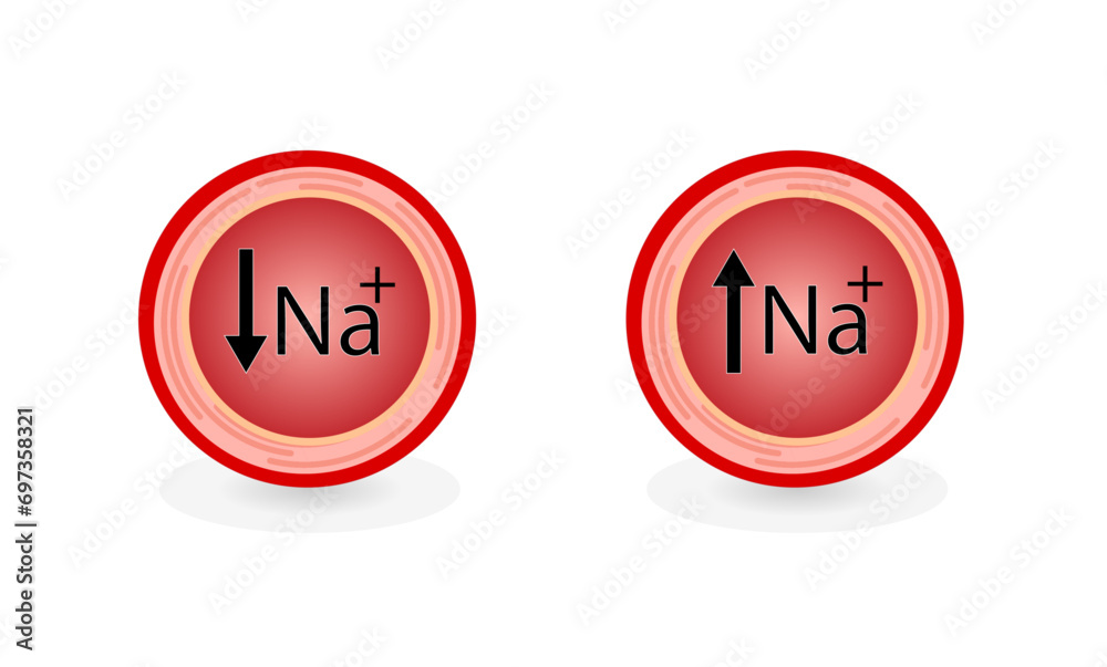 Hypernatremia, high plasma sodium level and Hyponatremia, low plasma ...