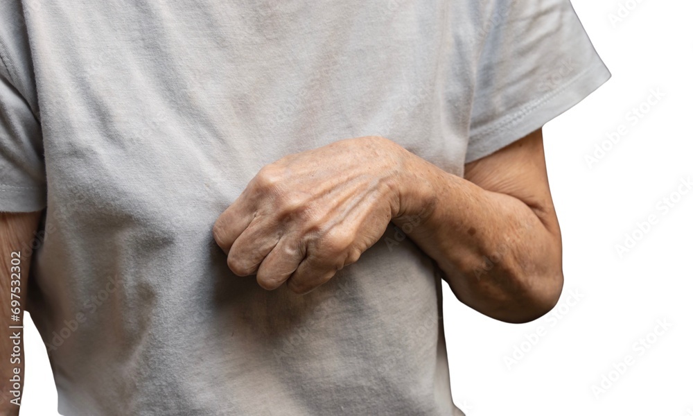 Foto de Hand of an man with Dupuytren contracture disease. Volkmann ...