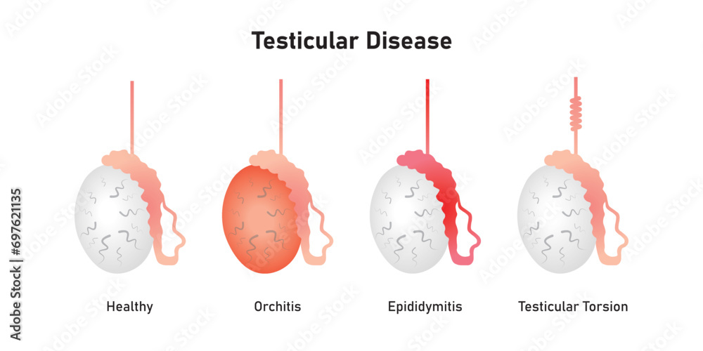 Testicular Disease Types Scientific Design. Vector Illustration. Stock ...