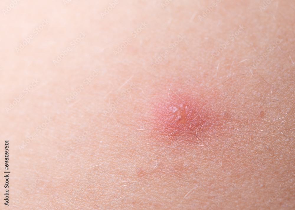 The child has spotted red pimples and a blistering rash from chickenpox ...