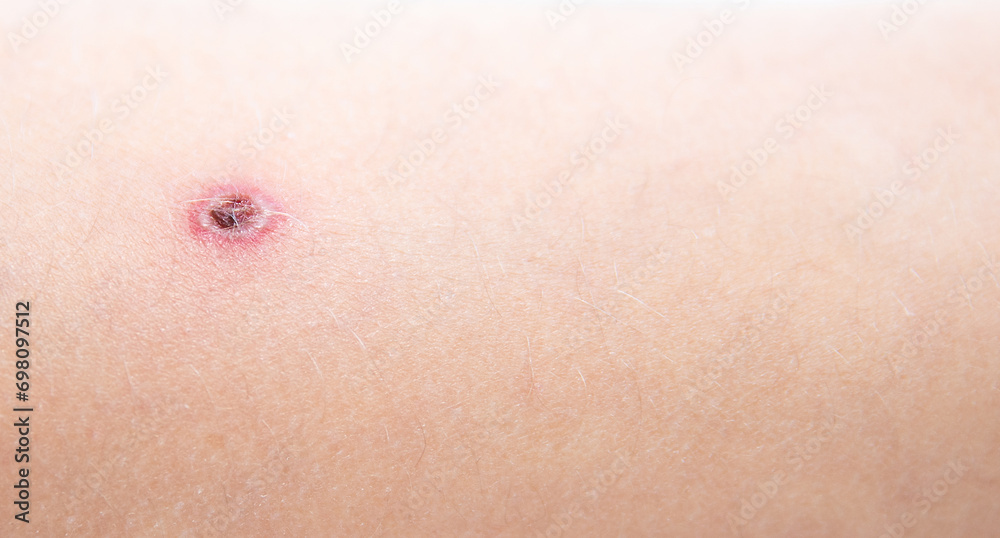 The child has spotted red pimples and a blistering rash from chickenpox ...