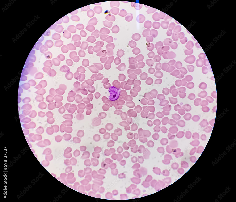 Plasmodium vivax in thin film under microscopy, Malaria disease. P ...
