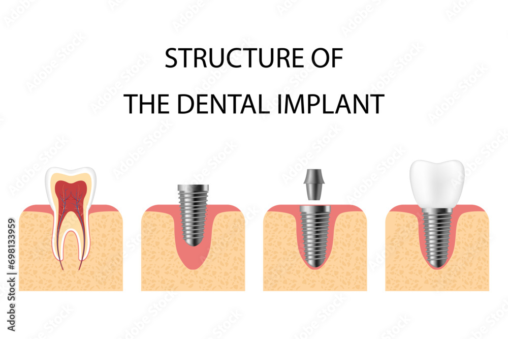 Dental implant. Screw prosthesis, orthodontic dental implantation Stock ...