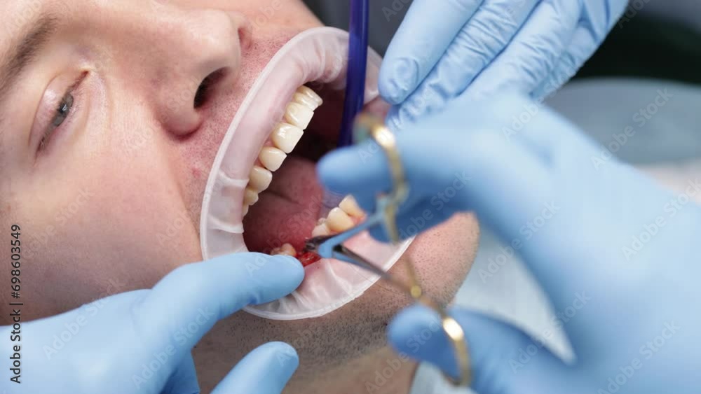 Stockvideon Suturing around healing abutment, often referred to as a ...