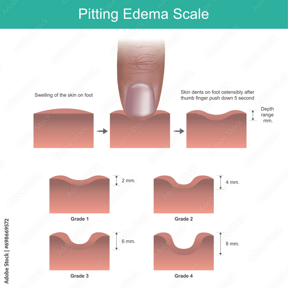 Pitting Edema Scale. Skin dents depth range measurement on foot after ...