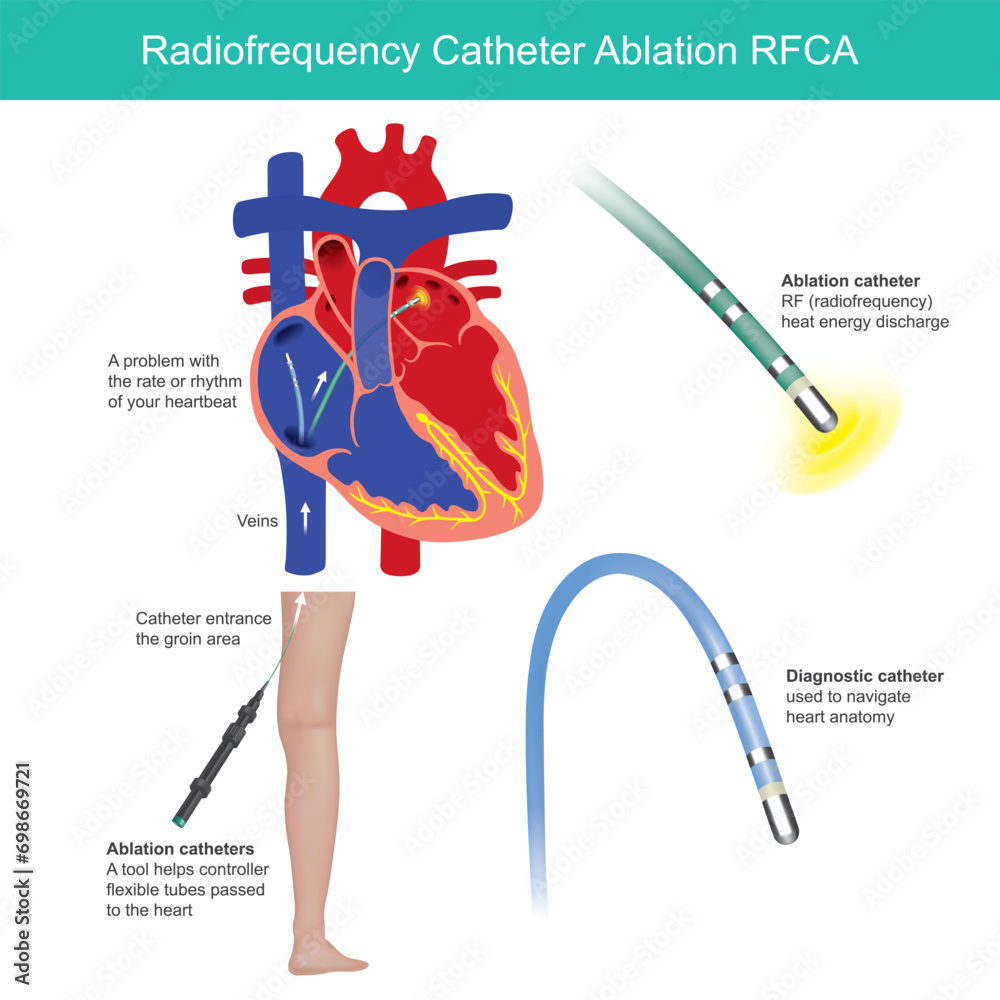 Radio Frequency Catheter Ablation Medical Procedure Is Used To Help