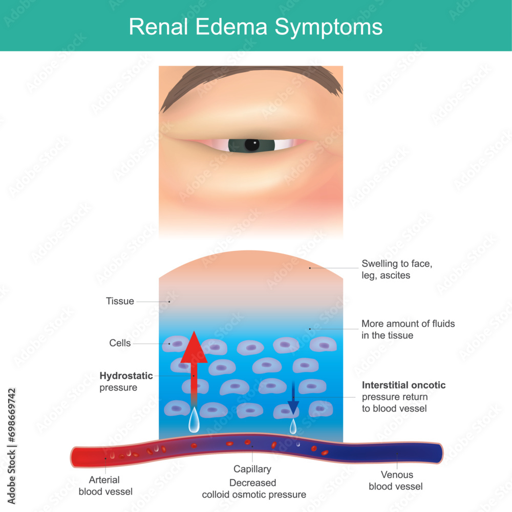 Renal Edema Symptoms. Severe swelling the medical called edema, occur ...