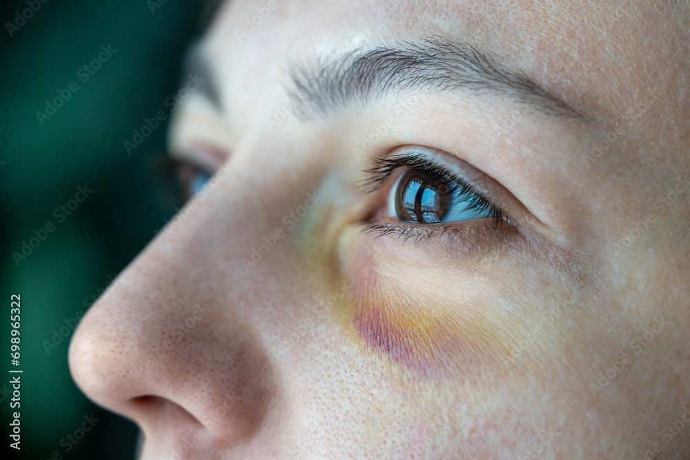 Injured wife with bruise under eye suffering domestic violence ...