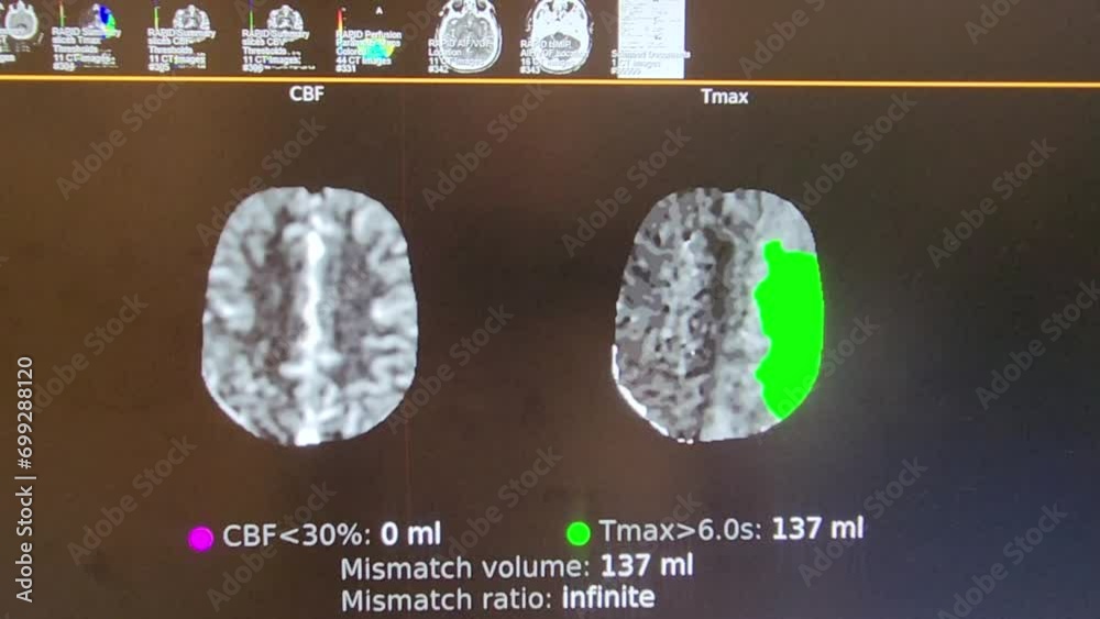 Brain Perfusion Imaging - Cerebral Angiography w CVA in Color Stock ...