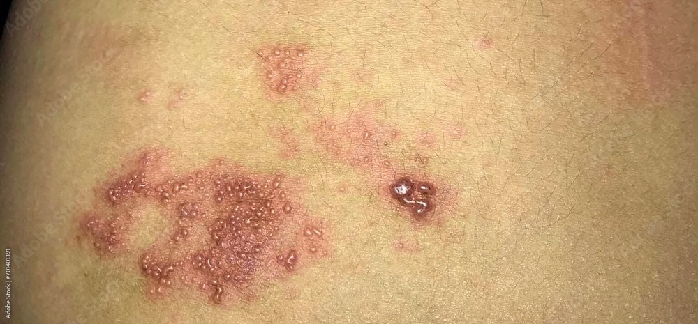 Herpes simplex infection at back of Asian patient. Small and painful ...