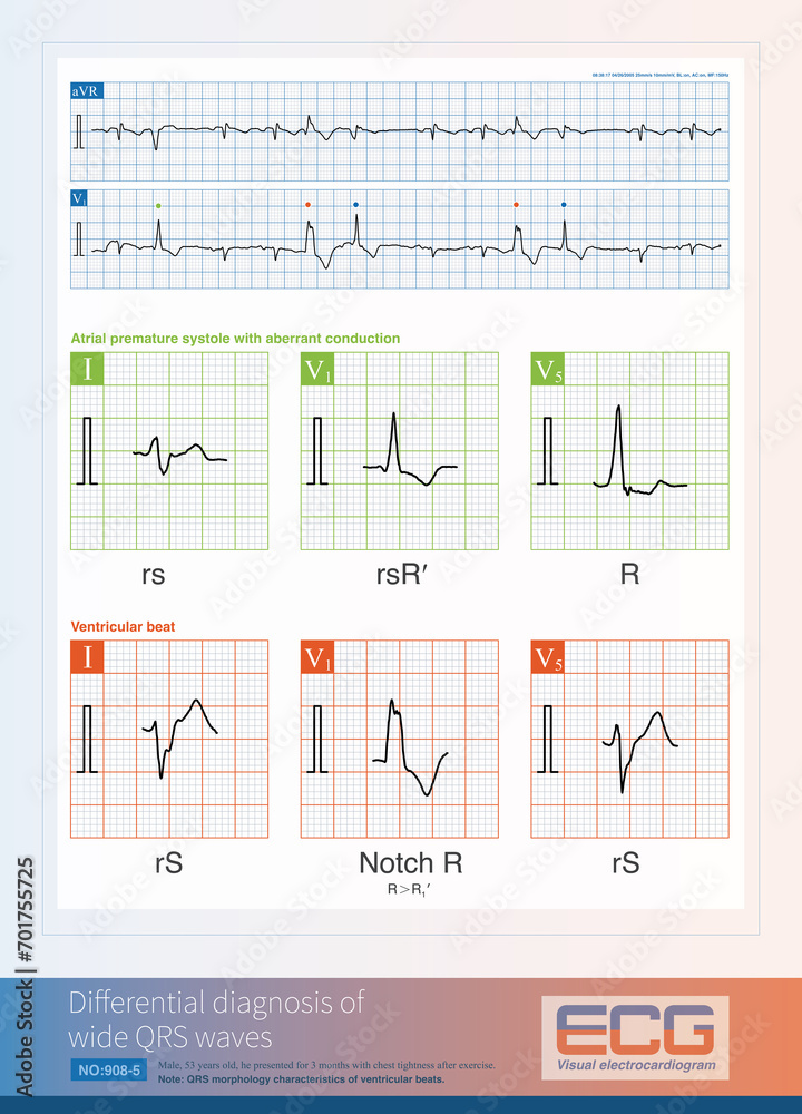 Ventricular beats originating in the left ventricle often appear as qR ...