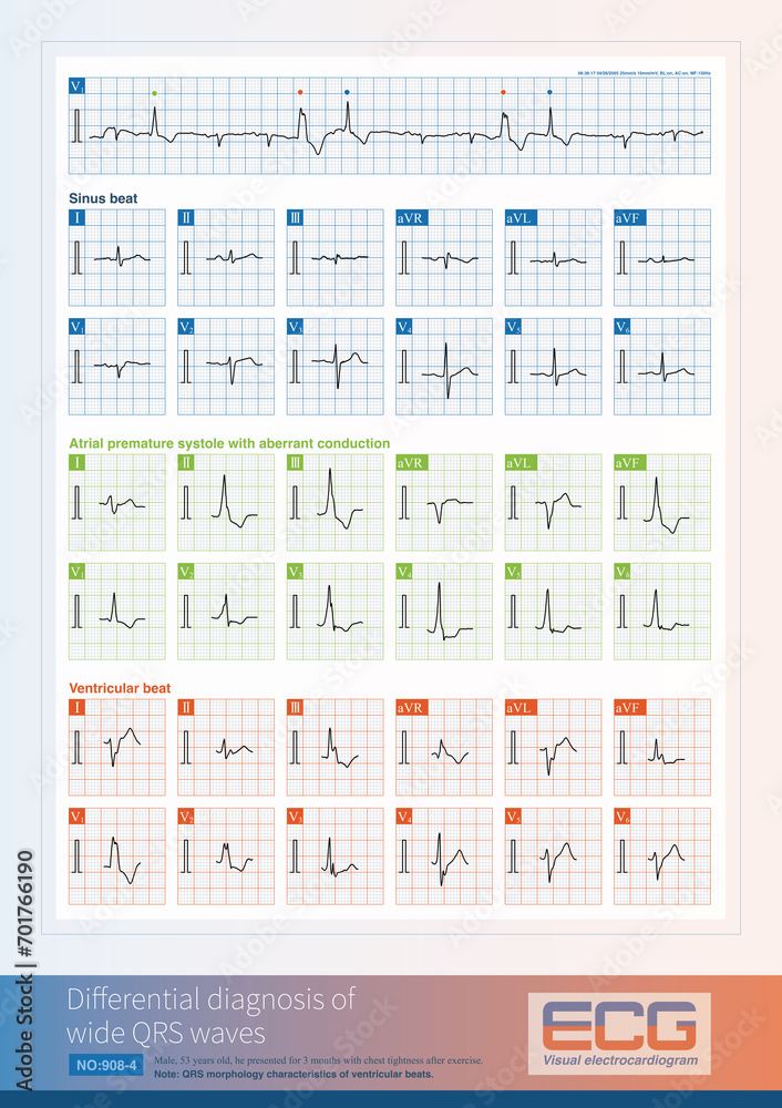 Poster This ECG has two morphologies of the wide QRS complex and is ...