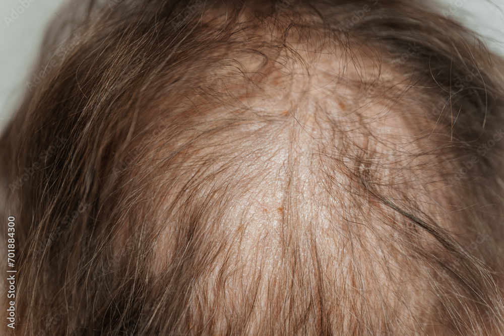 fallen hair from a woman's head due to a cancerous tumor. balding ...