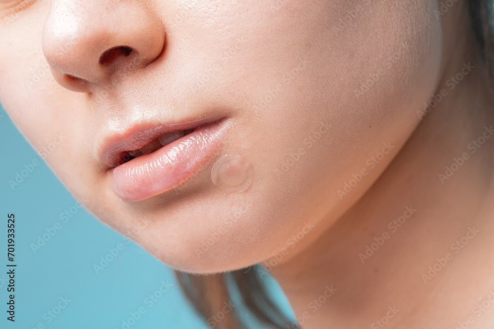 Girl with acne stick round acne patch on her cheek. Using acne patches ...