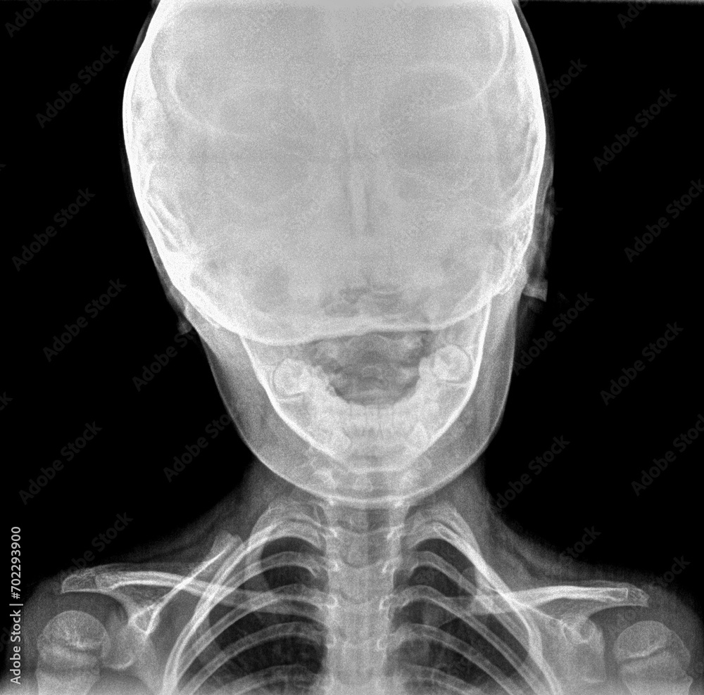 Normal film xray or radiograph of a cervical neck of a small child. AP ...