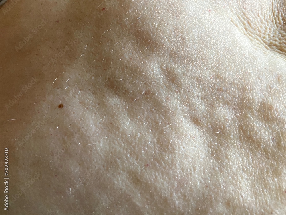 Poster cellulite texture skin background surface with cellulite skin ...