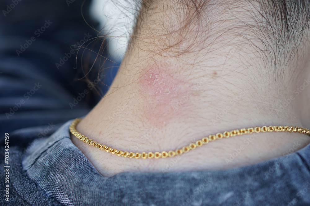 Allergic skin on neck wears gold necklace. A skin disorder of atopic ...