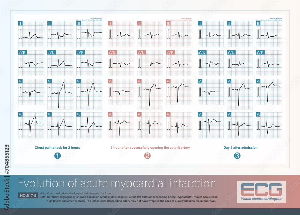 Male, 65 years old, was clinically diagnosed with acute anterior ...