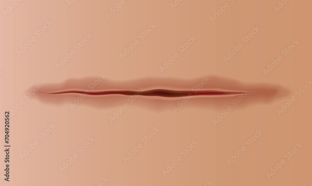 Healing wounds, skin scar, stitched gash and cut. Realistic surgical ...