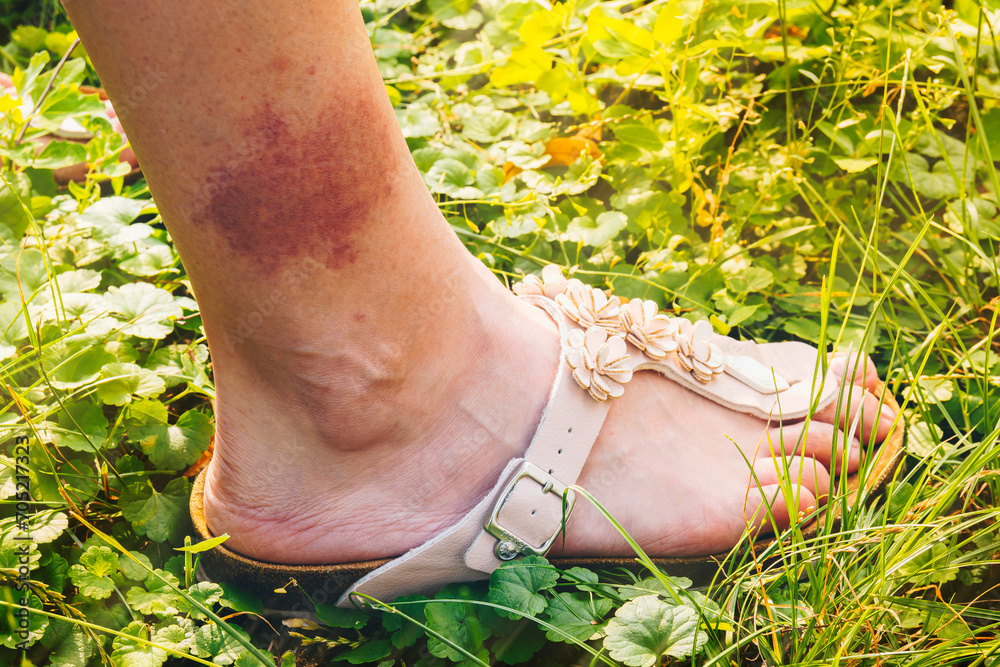 Lyme disease, borreliosis or borreliosis, typical Lyme rash, spots. A ...