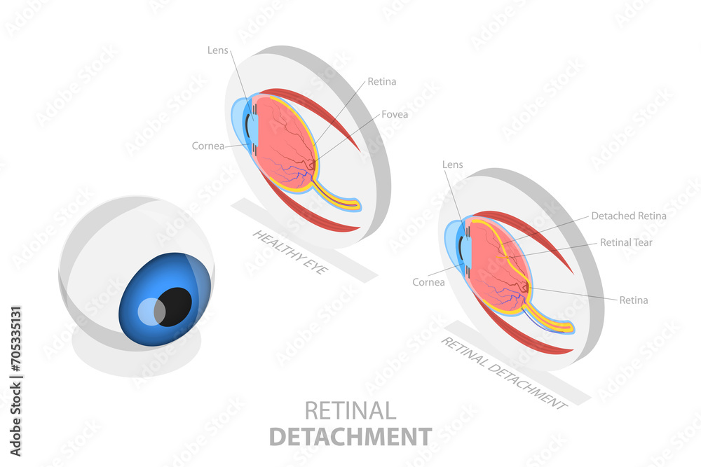 3D Isometric Flat Conceptual Illustration of Retinal Detachment ...