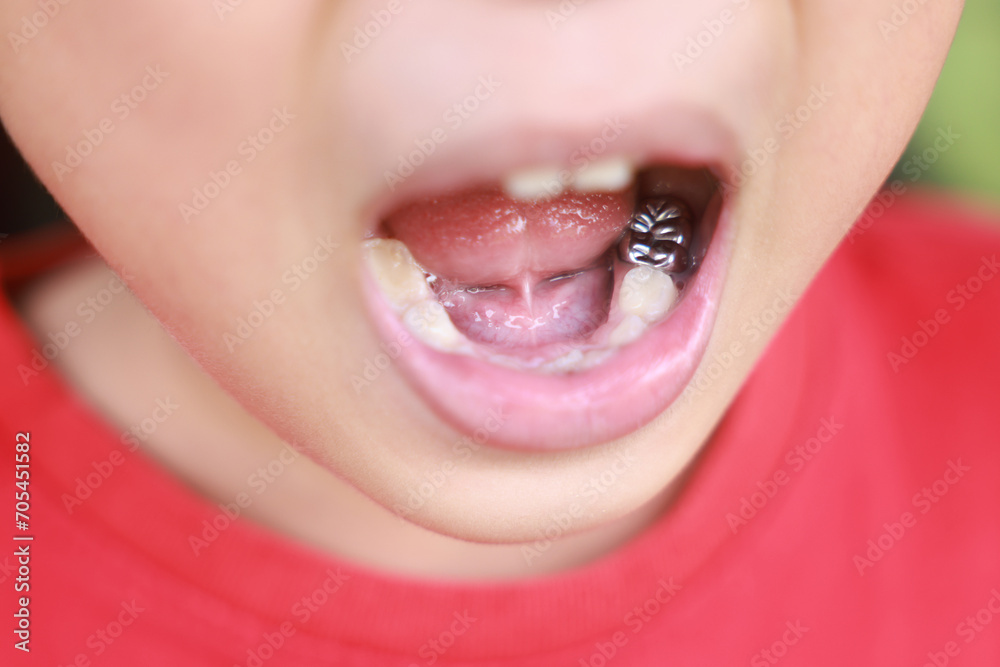 Child milk teeth fall out from gum. little boy permanent tooth grows in ...
