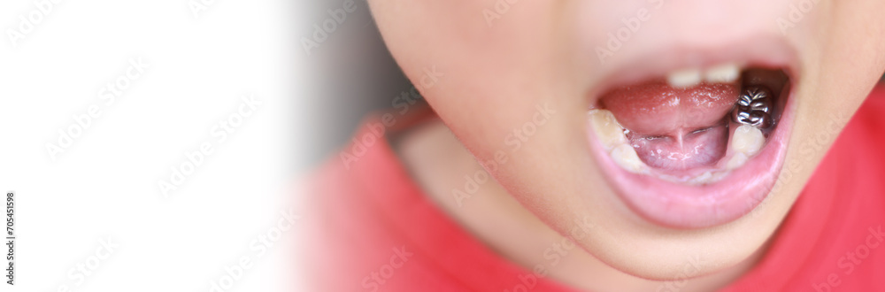 Child milk teeth fall out from gum. little boy permanent tooth grows in ...