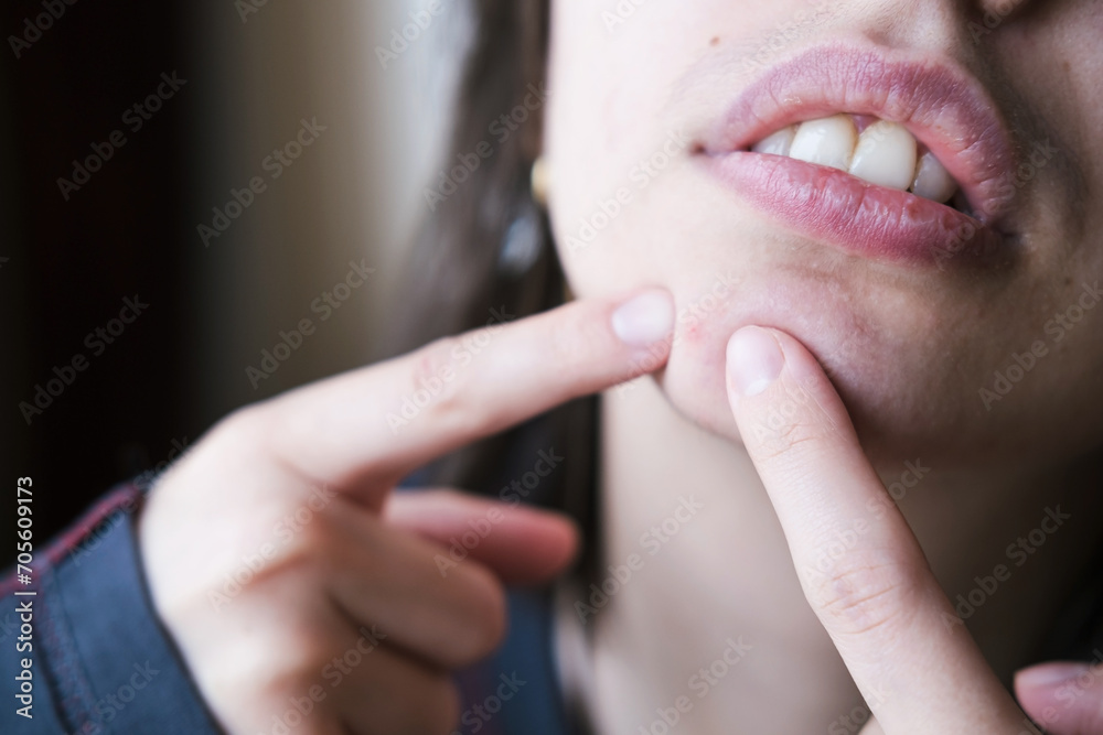 Portrait of a young girl without makeup with acne on her face. Girl ...