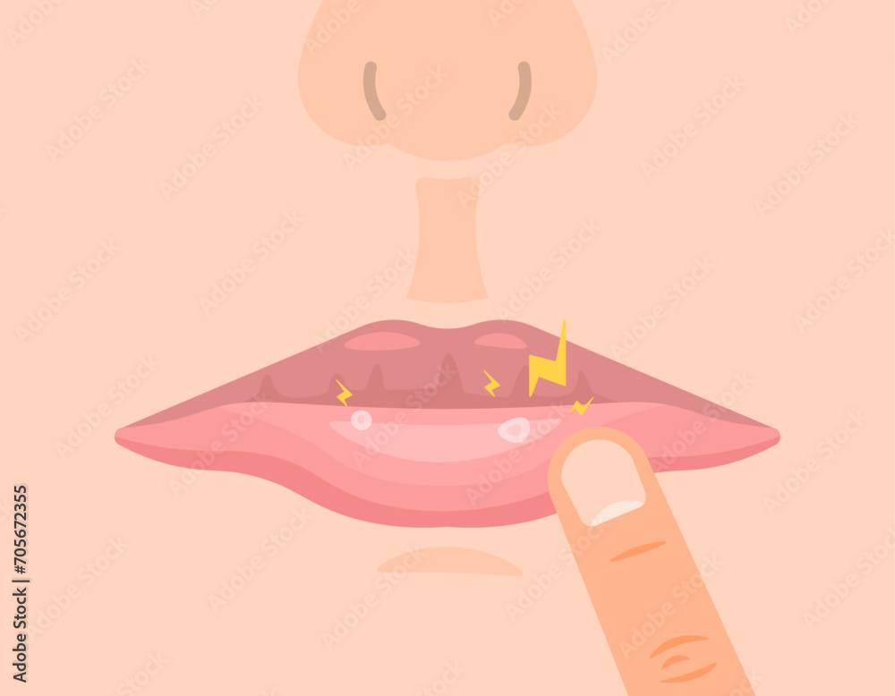 an illustration of the appearance of canker sores in the mouth. mouth ...