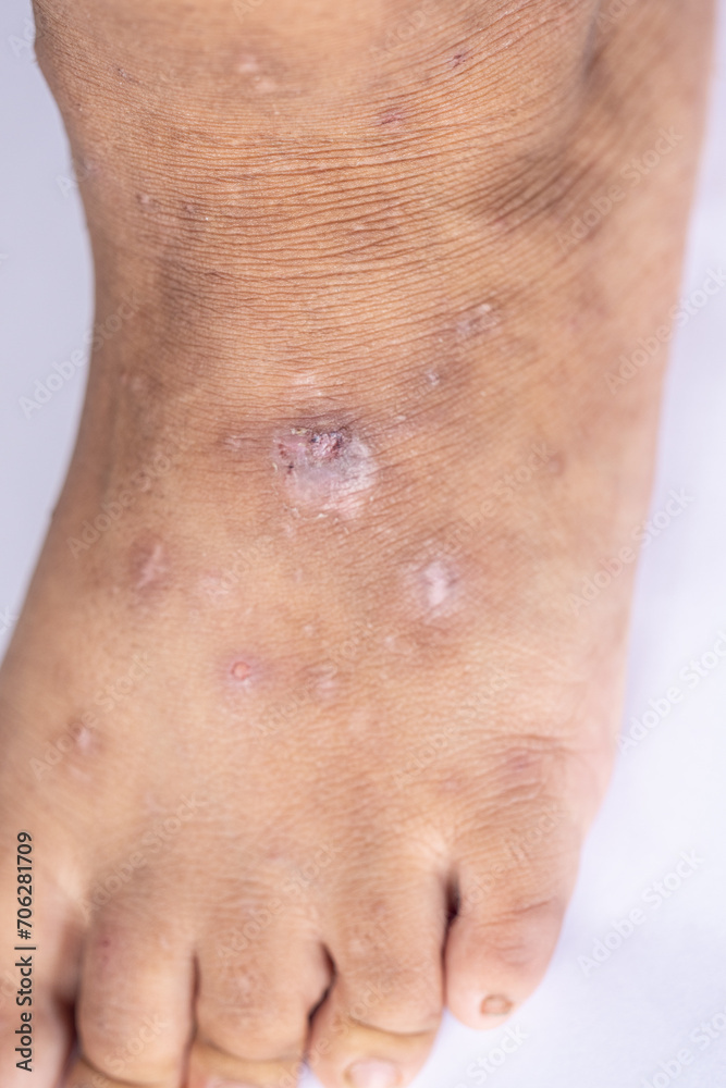 Atopic dermatitis (AD), also known as atopic eczema, is a type of ...