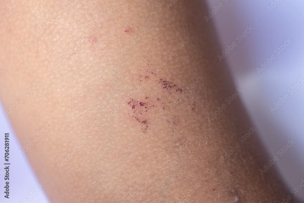 Atopic dermatitis (AD), also known as atopic eczema, is a type of ...