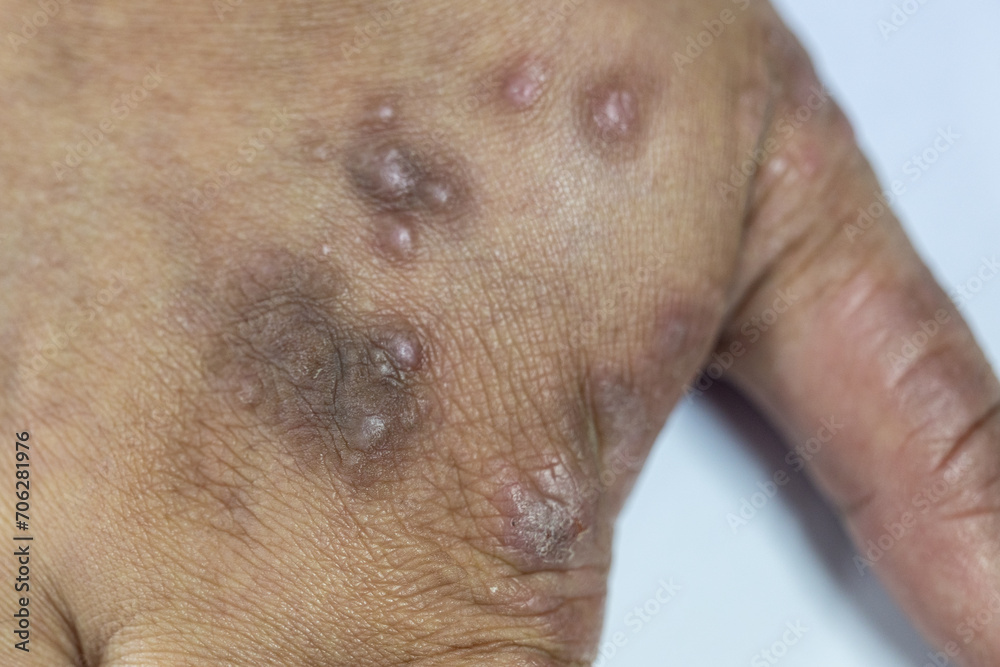 Atopic dermatitis (AD), also known as atopic eczema, is a type of ...