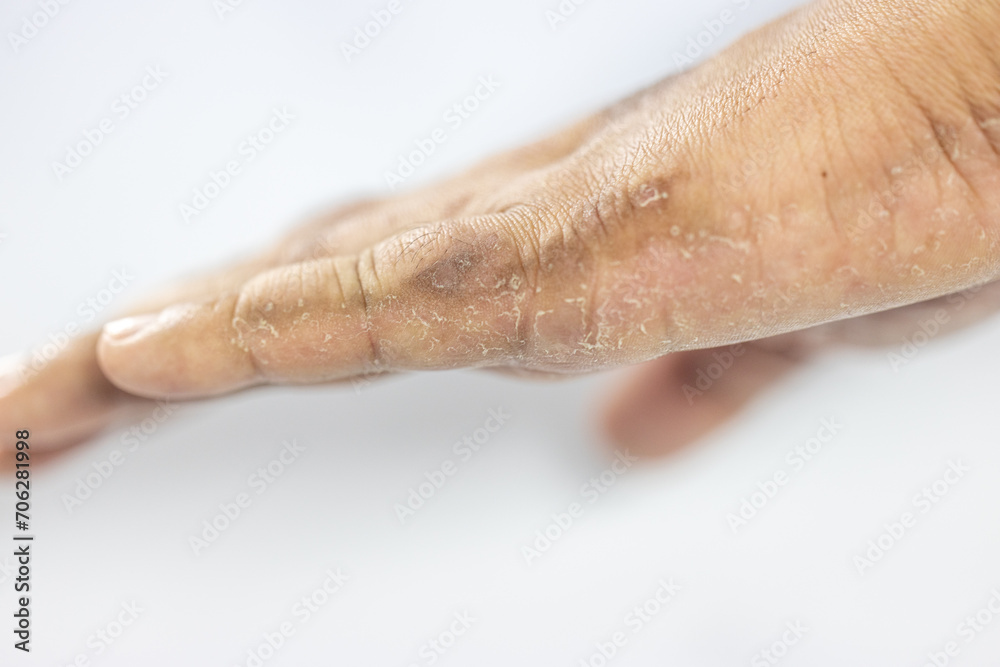 Atopic dermatitis (AD), also known as atopic eczema, is a type of ...